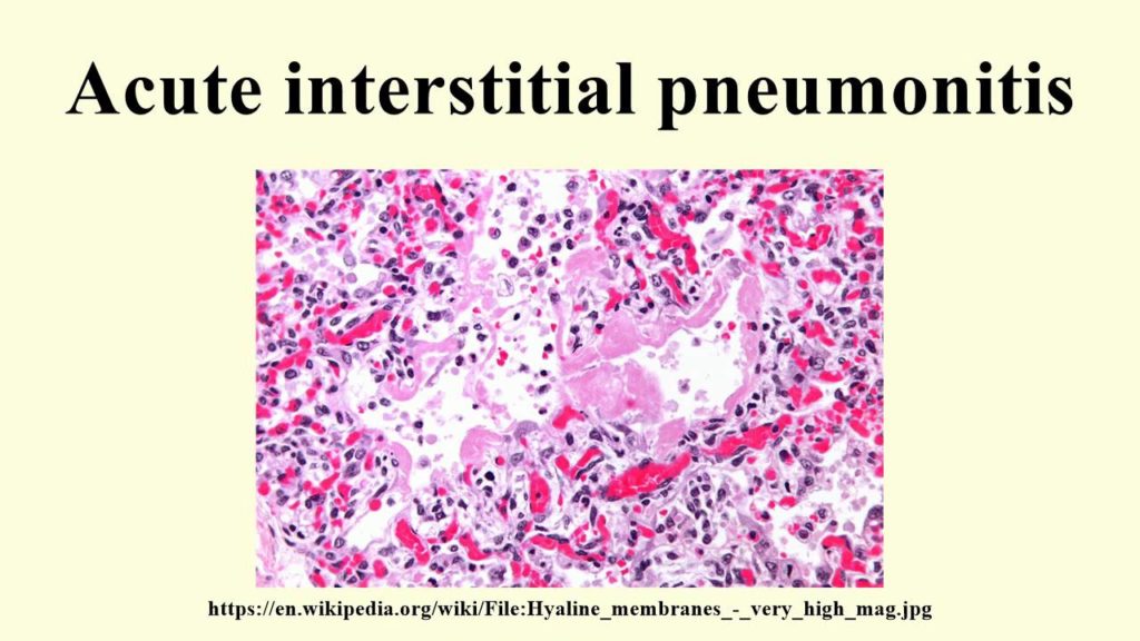 Interstitial Pneumonitis – NutriMedical