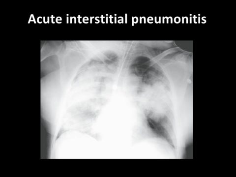 Interstitial Pneumonitis – NutriMedical